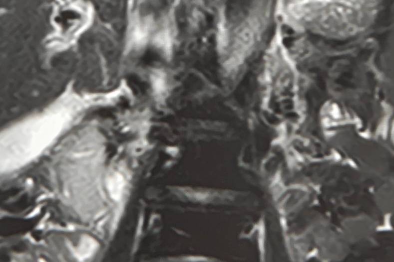 肝格林森氏鞘水肿_Glisson_肝脏_系统