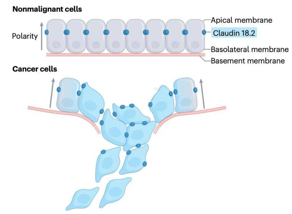 信达差异化布局CLDN18.2 ADC和双抗，胰腺癌等瘤种最新进展汇总_患者_治疗_Claudin