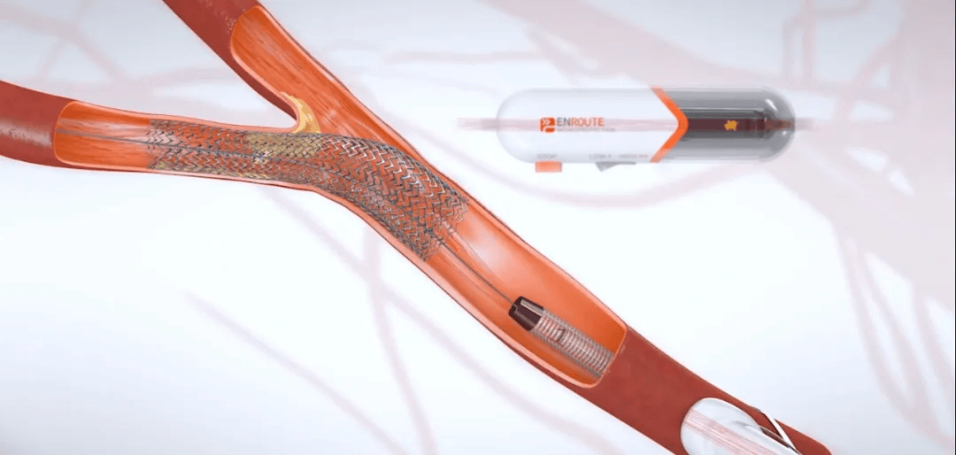 技术动态 | 与TCAR相比 CEA手术可改善长期结局 一项大型单中心分析显示_研究_差异_死亡率