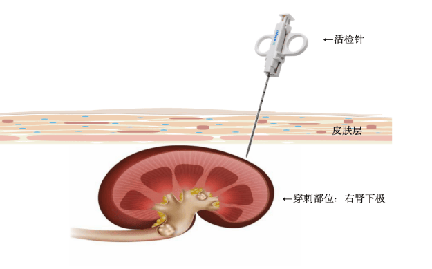 “增”新院 | 增城院区多学科联合，破解肾脏谜题_诊断_儿童_疾病