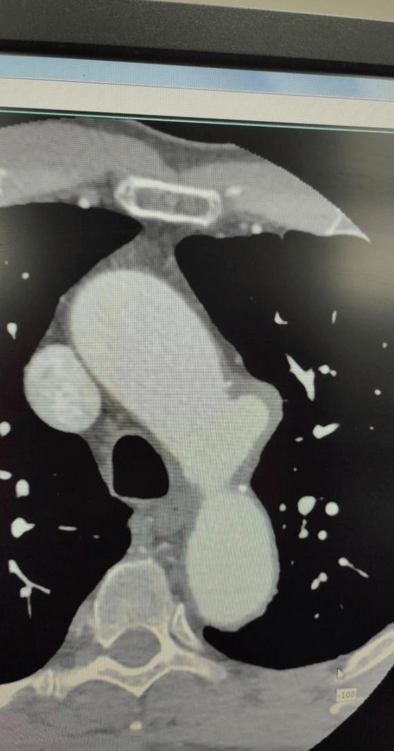 昭通首例¦WeFlow-Tbranch单分支分体式胸主动脉覆膜支架植入手术在昭通市第三人民医院顺利完成_患者_团队_蔡红波