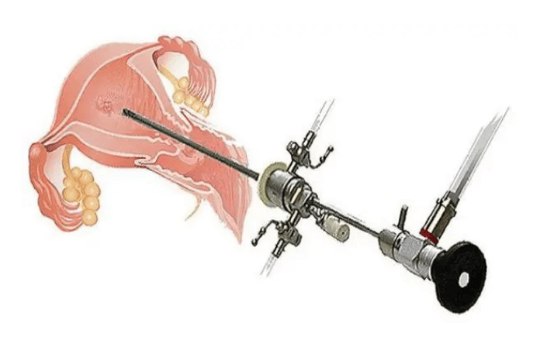 一分钟带你认识宫腔镜_手术_子宫_内膜