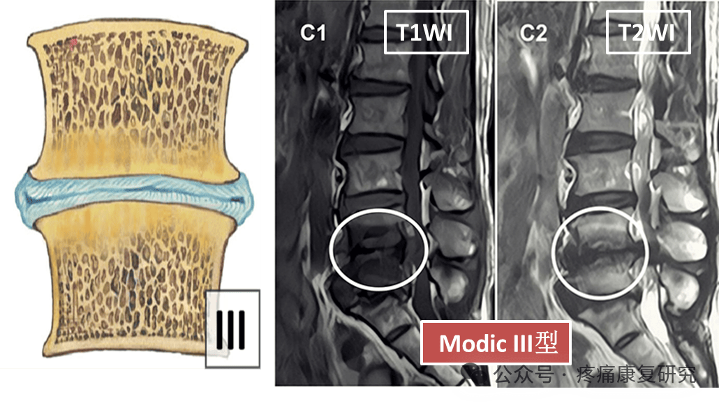 腰痛：椎体终板炎的解剖、分型及MRI表现_Modic_椎间盘_信号特征